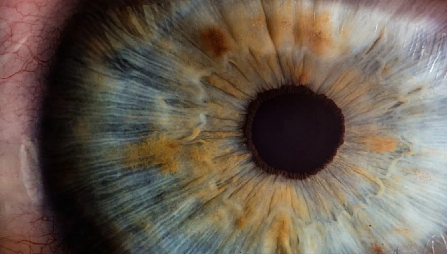 Macular Hole | What is a Macular Hole? | Optegra