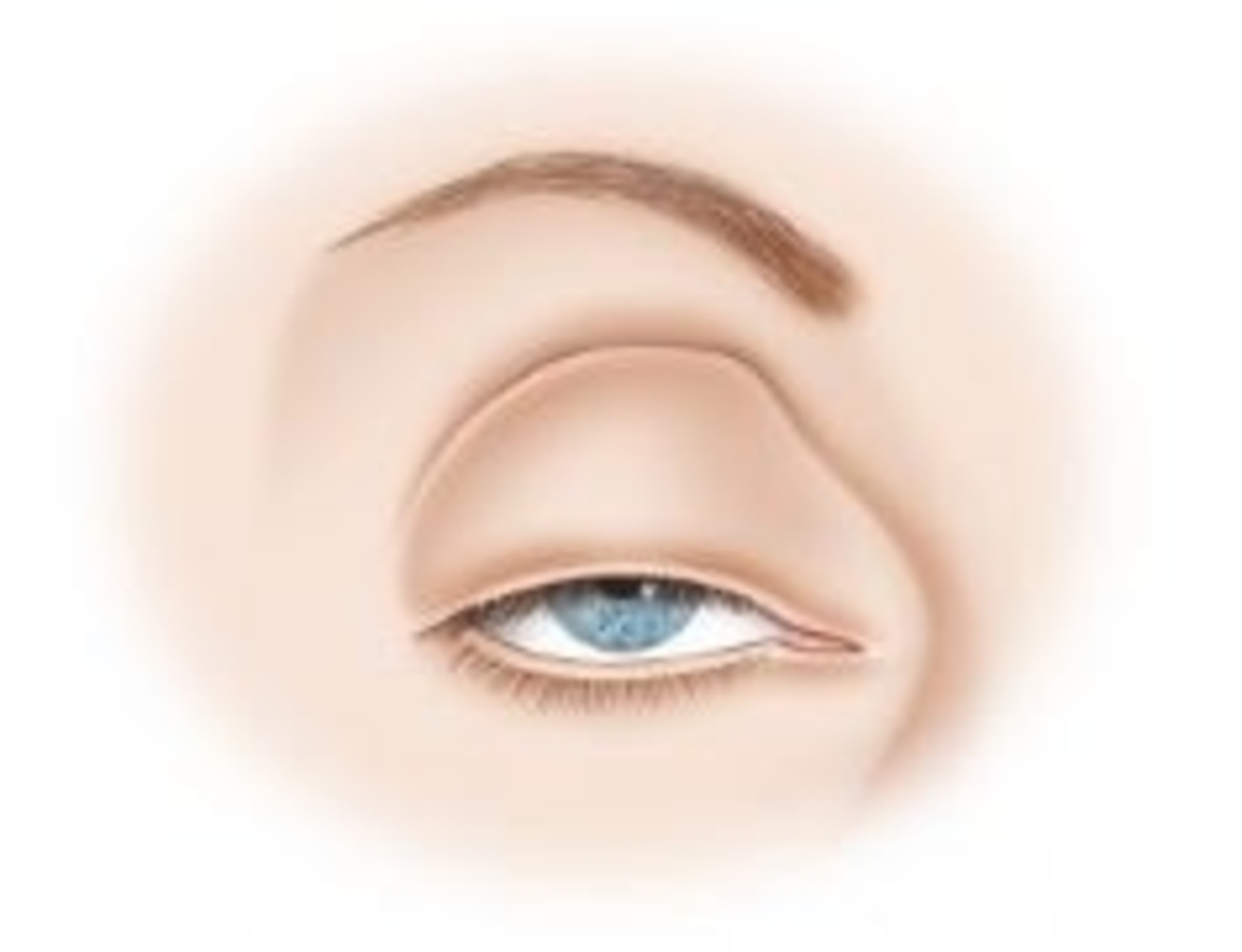 Droopy Eyelid How To Fix Droopy Eyelids Optegra