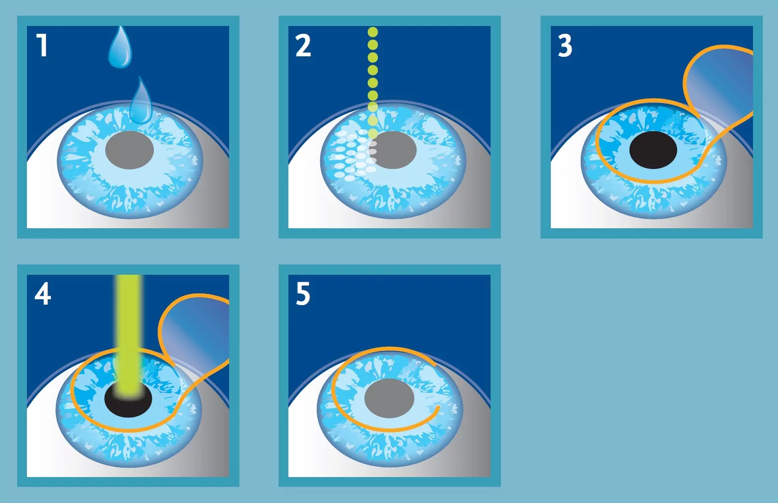 Laser Eye Surgery | Top Rated UK Laser Eye Surgeons
