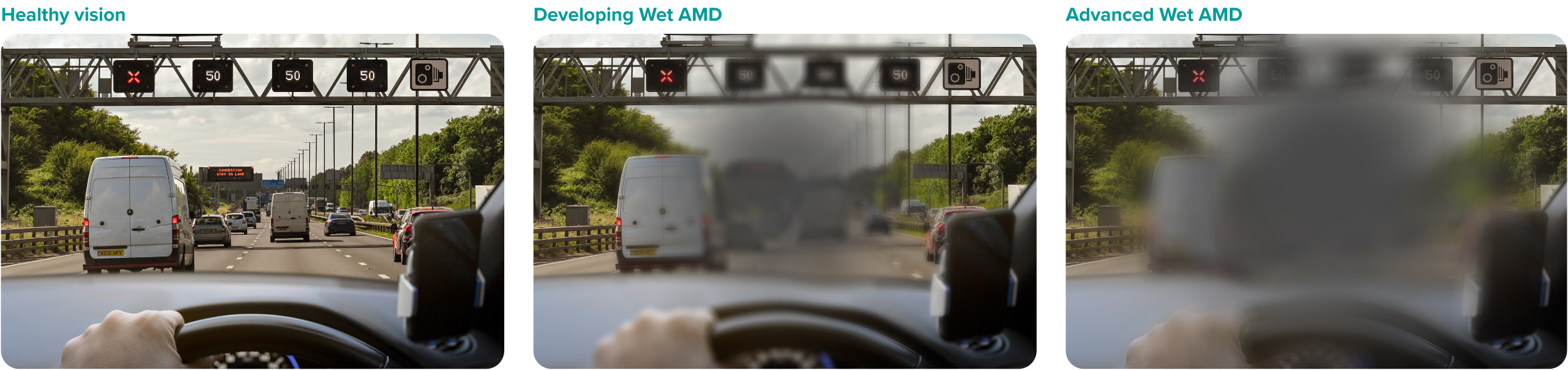 Wet AMD Treatment | Wet Age Related Macular Degeneration