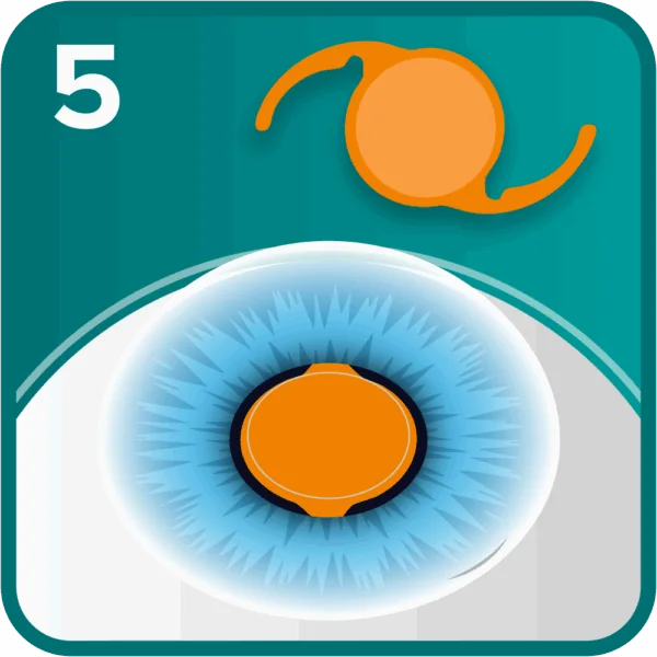 Lens Replacement Surgery | Eye Lens Replacement | Optegra