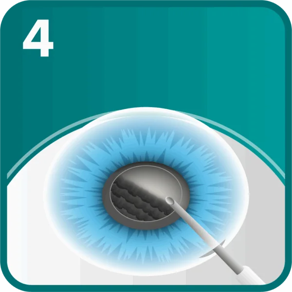 Private Cataract Surgery | Free Consultation within Days